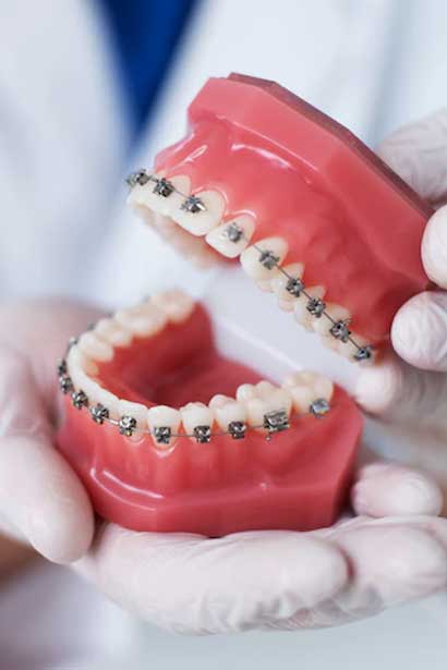 Metal Braces in El Monte CA - Atlas Dental Care and Orthodontics